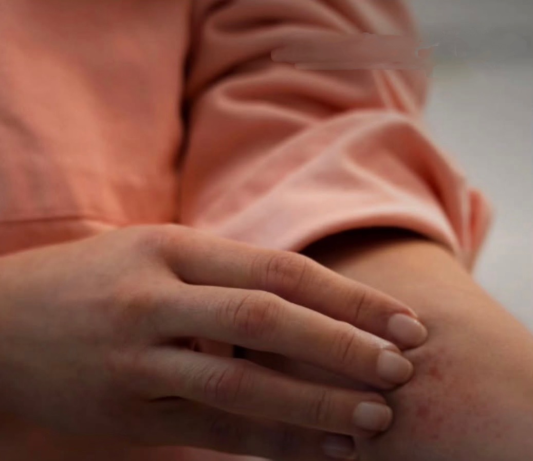 SUS passa a oferecer tratamento integral para dermatite atópica